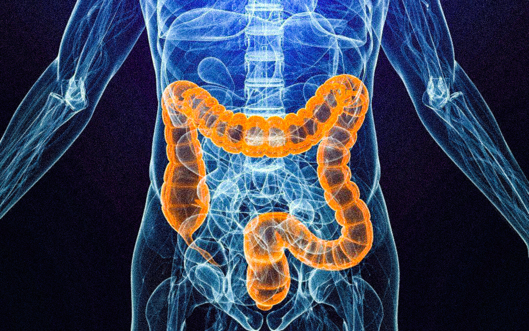 What is Colon Cancer - Symptoms, Causes, Diagnosis and Treatment