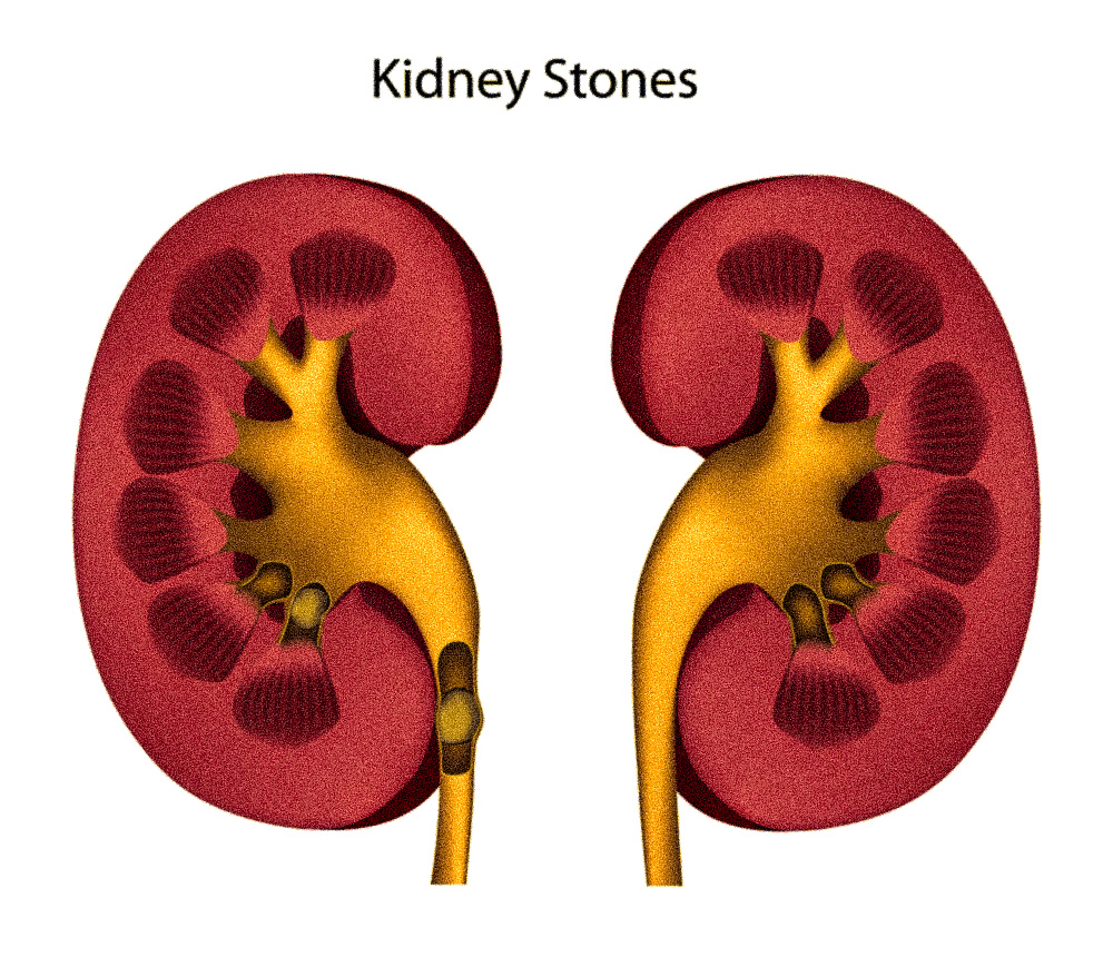 What is Kidney Stone - Types, Symptoms, Causes, Diagnosis and Treatment